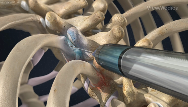 Spinal Injections for Pain Management – Synergex Med Blog